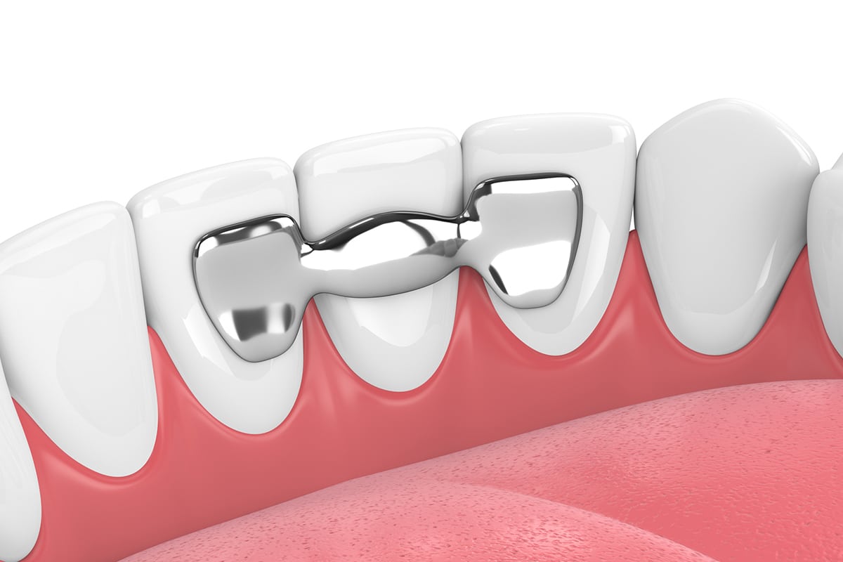 How Long Do Dental Bridges Last? | Fort Collins